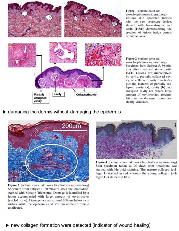 LIOB in Picosecond laser > 최신뉴스 | 대한임상피부치료연구회(대피연)